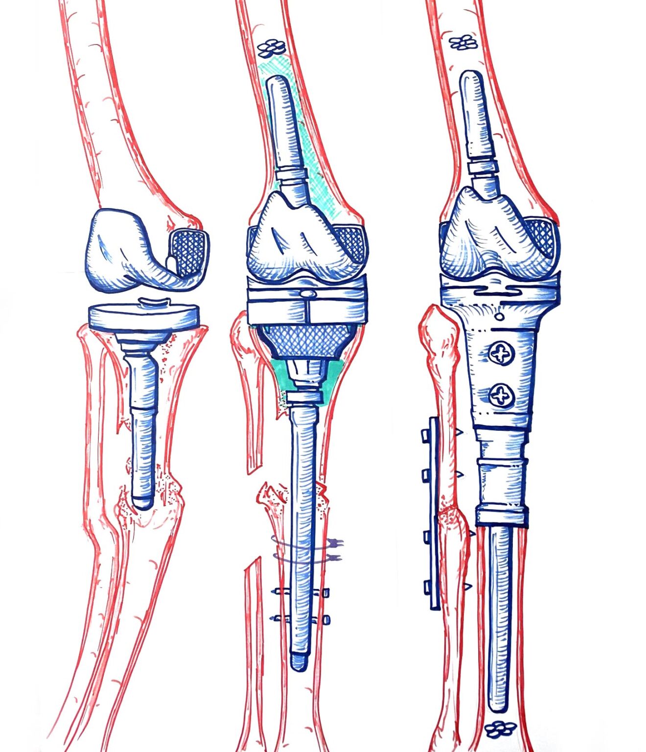Knee Revision | Mr Ilan Freedman