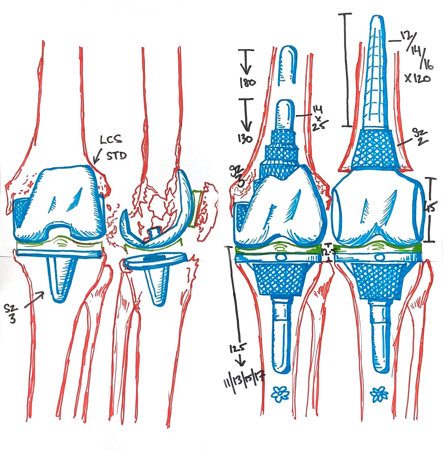Knee Revision | Mr Ilan Freedman