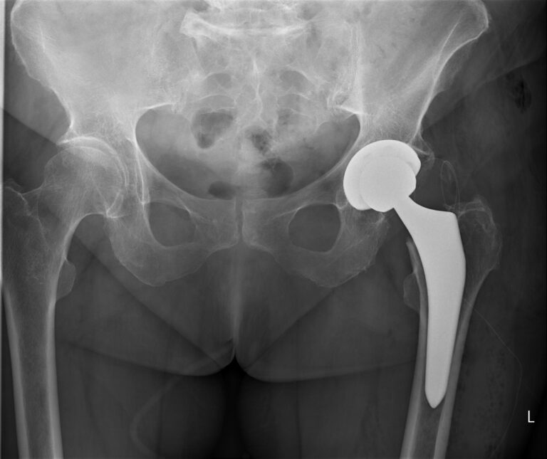 Direct Anterior Approach for Hip Fractures - Melbourne Orthopaedic ...